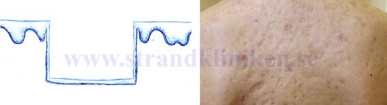 Acneärr Stockholm - Strandkliniken